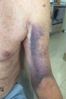 [Case Study] Brian's recovery from a complete rotator cuff tear ...